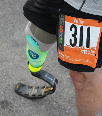 Amputee Blade Runners – We offer free running legs, through grants, to ...